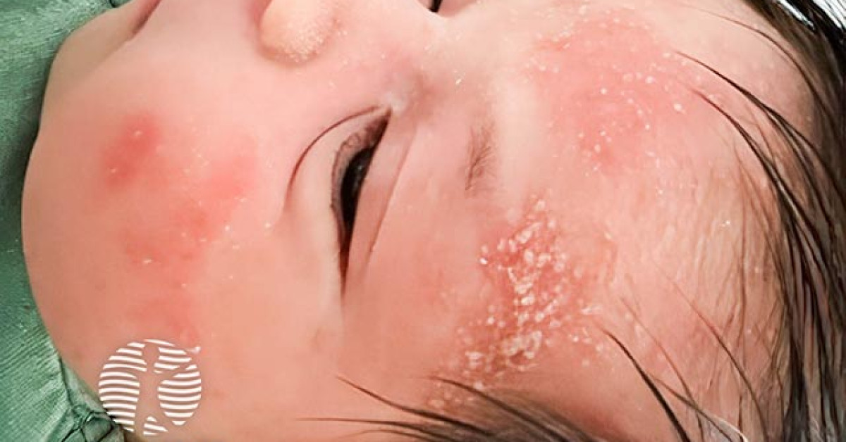 Eosinophilic pustular folliculitis image