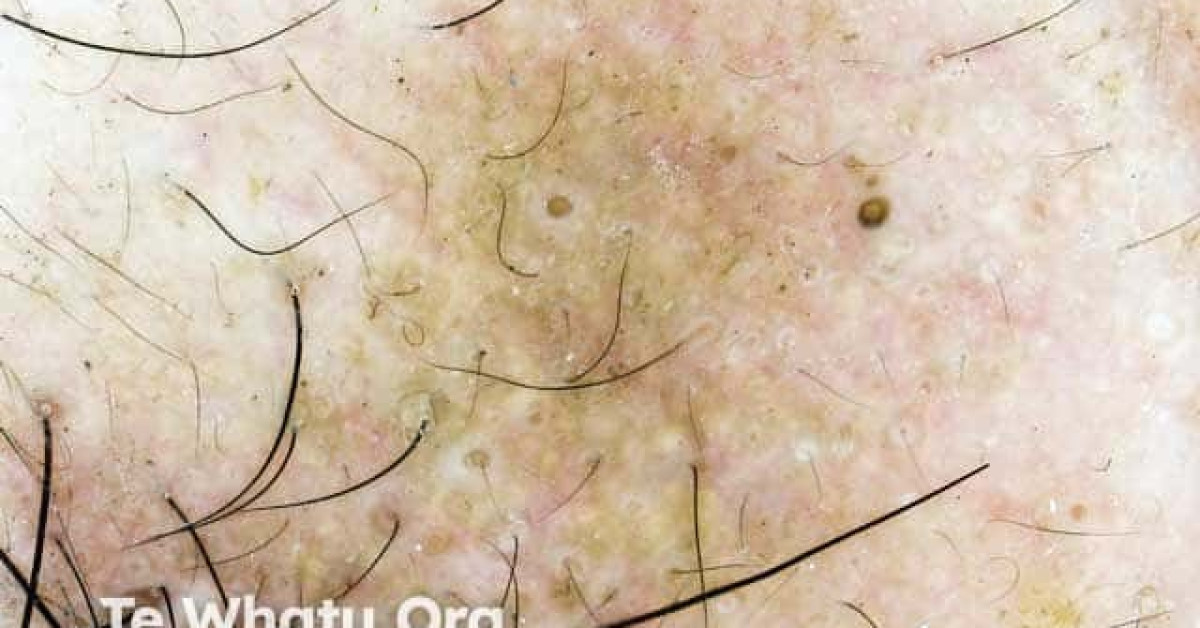 Epidermal naevus image