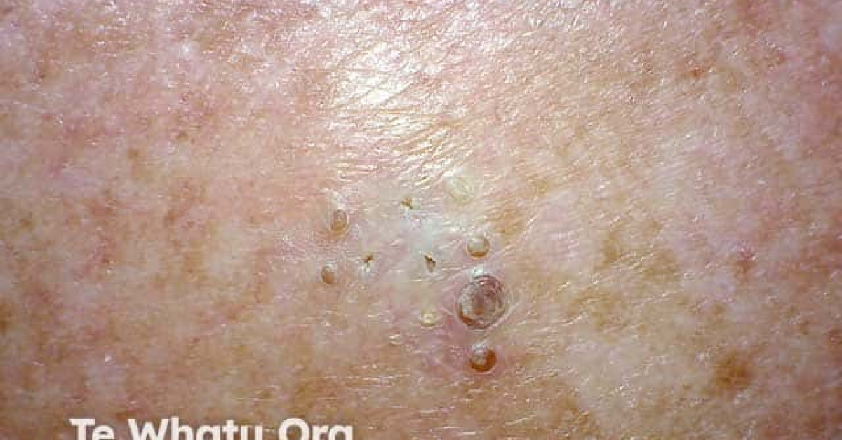 Epidermal naevus image