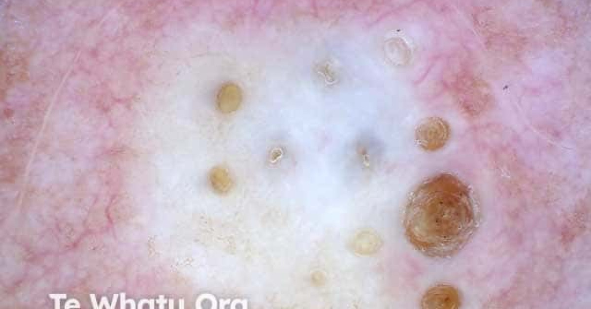 Epidermal naevus image