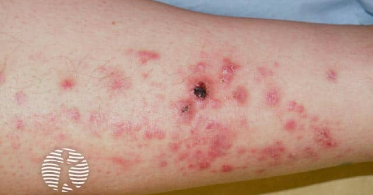 Epidermolysis bullosa pruriginosa image