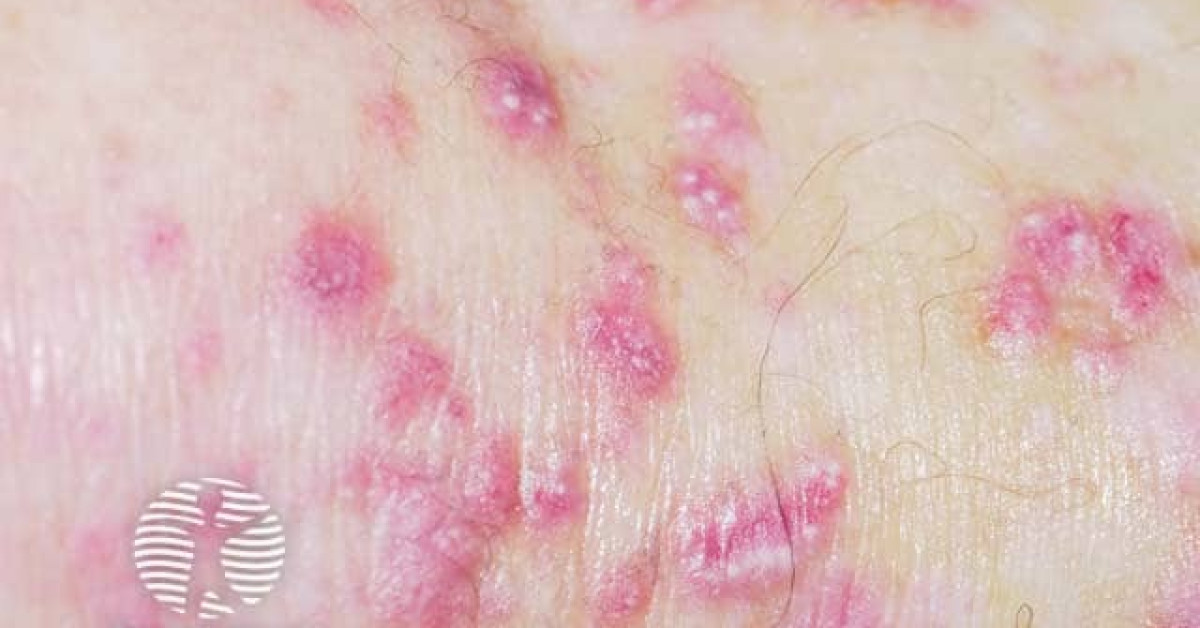 Epidermolysis bullosa pruriginosa image