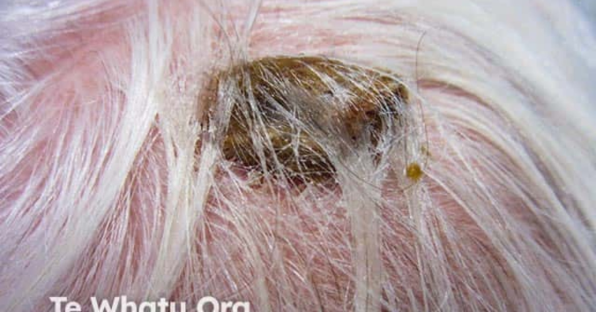 Erosive pustular dermatosis of the scalp image