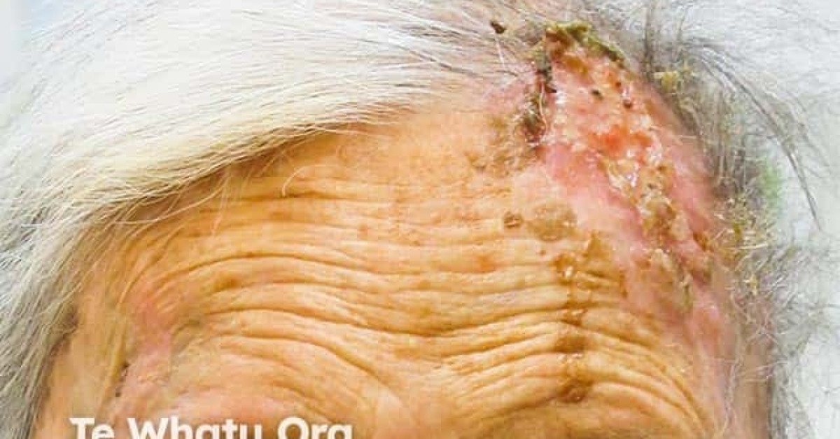 Erosive pustular dermatosis of the scalp image