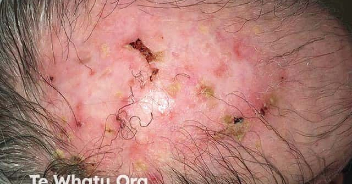Erosive pustular dermatosis of the scalp image