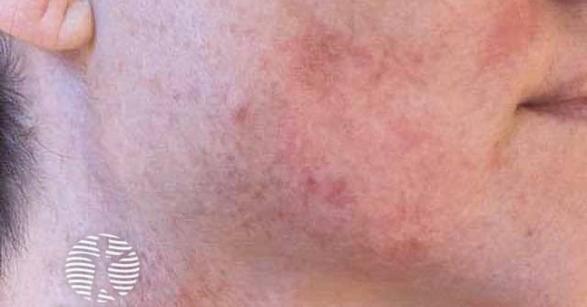 Face mask dermatitis image