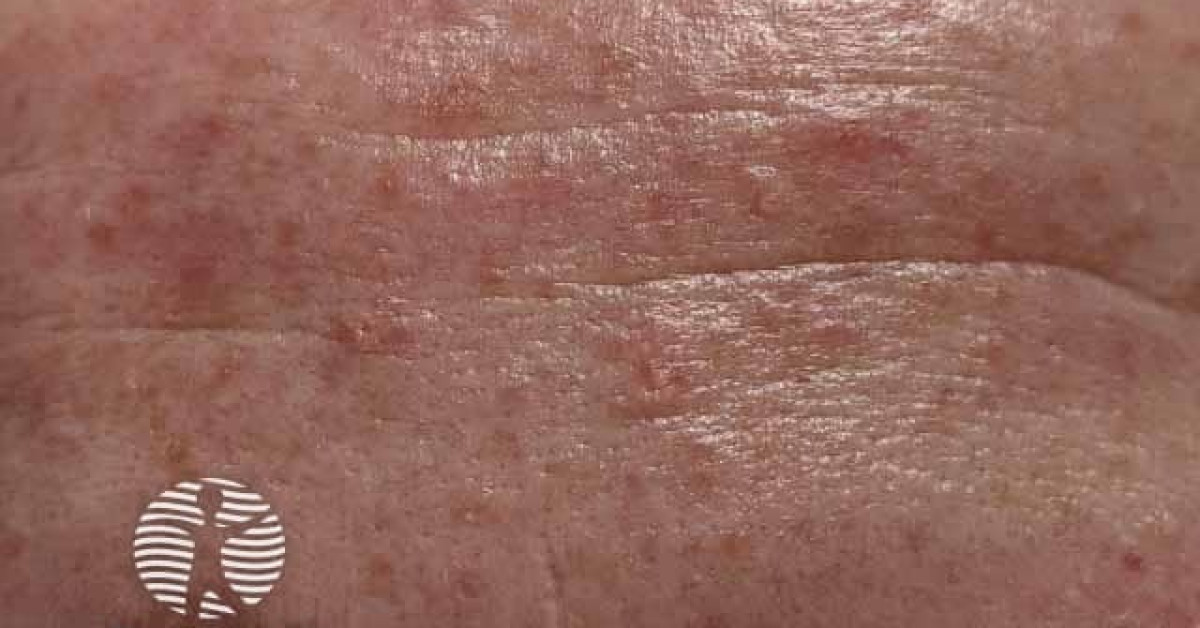Face mask dermatitis image