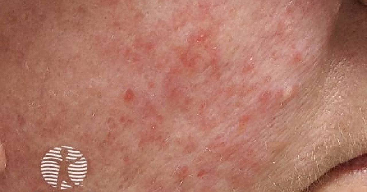 Face mask dermatitis image
