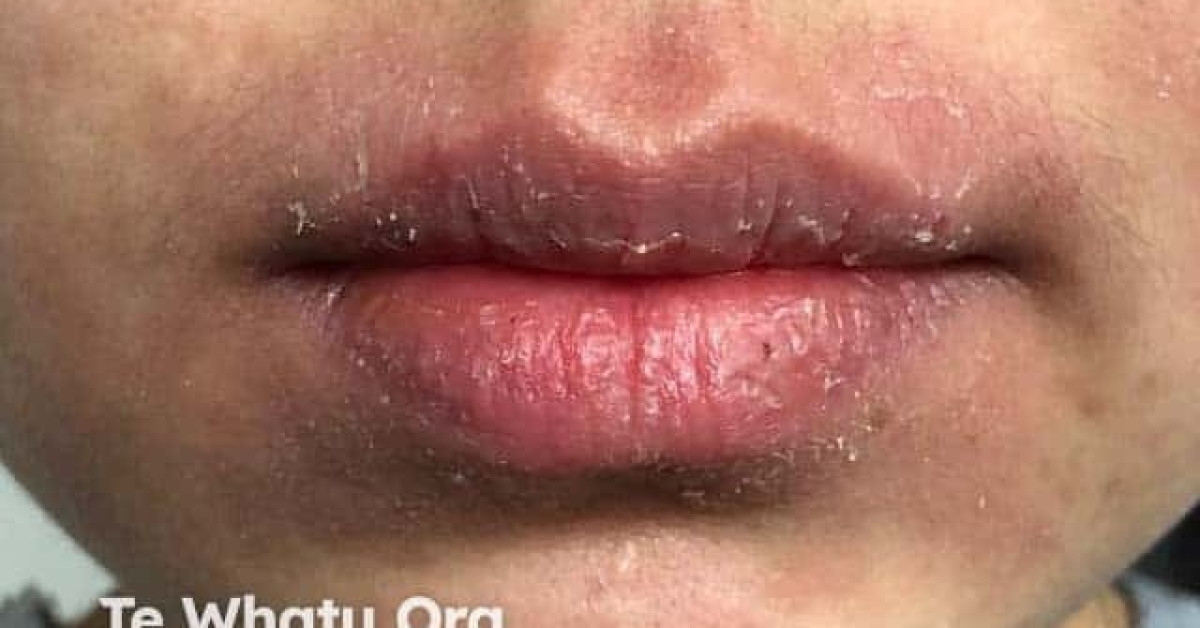 Face mask dermatitis image