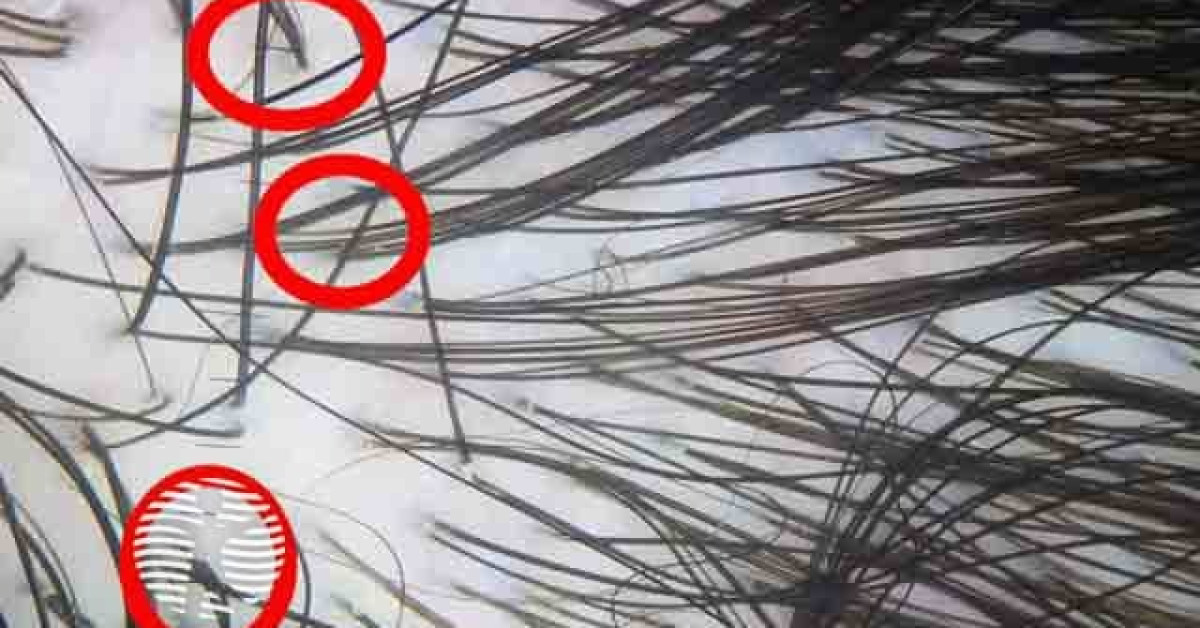 Female pattern hair loss image