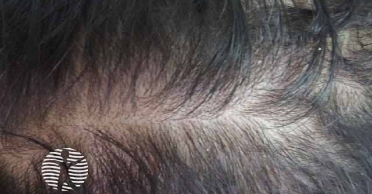 Female pattern hair loss image