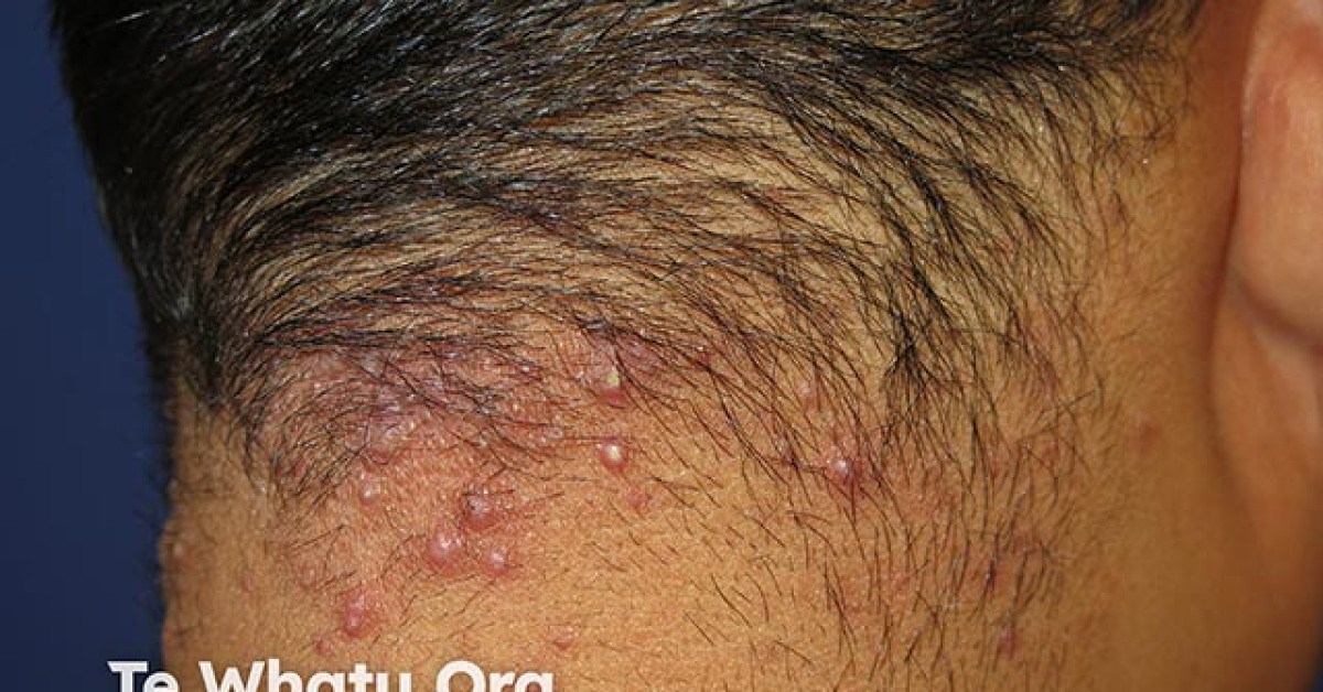 Folliculitis keloidalis image