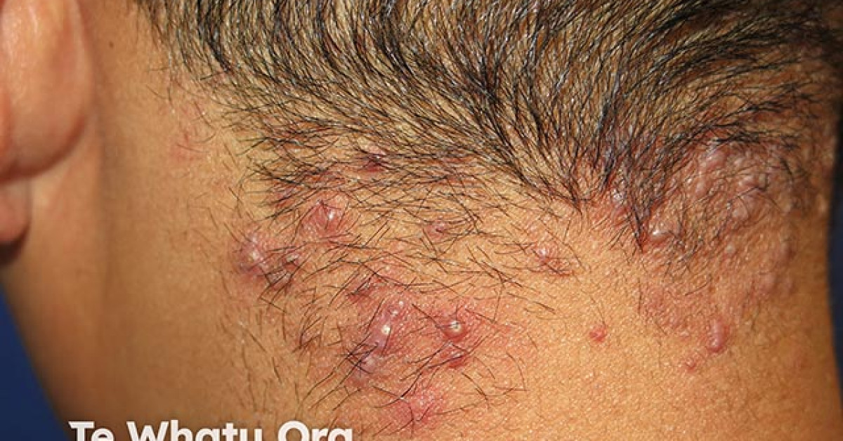 Folliculitis keloidalis image