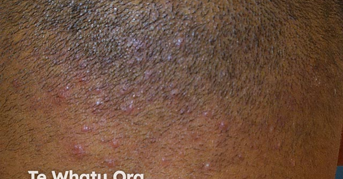 Folliculitis keloidalis image