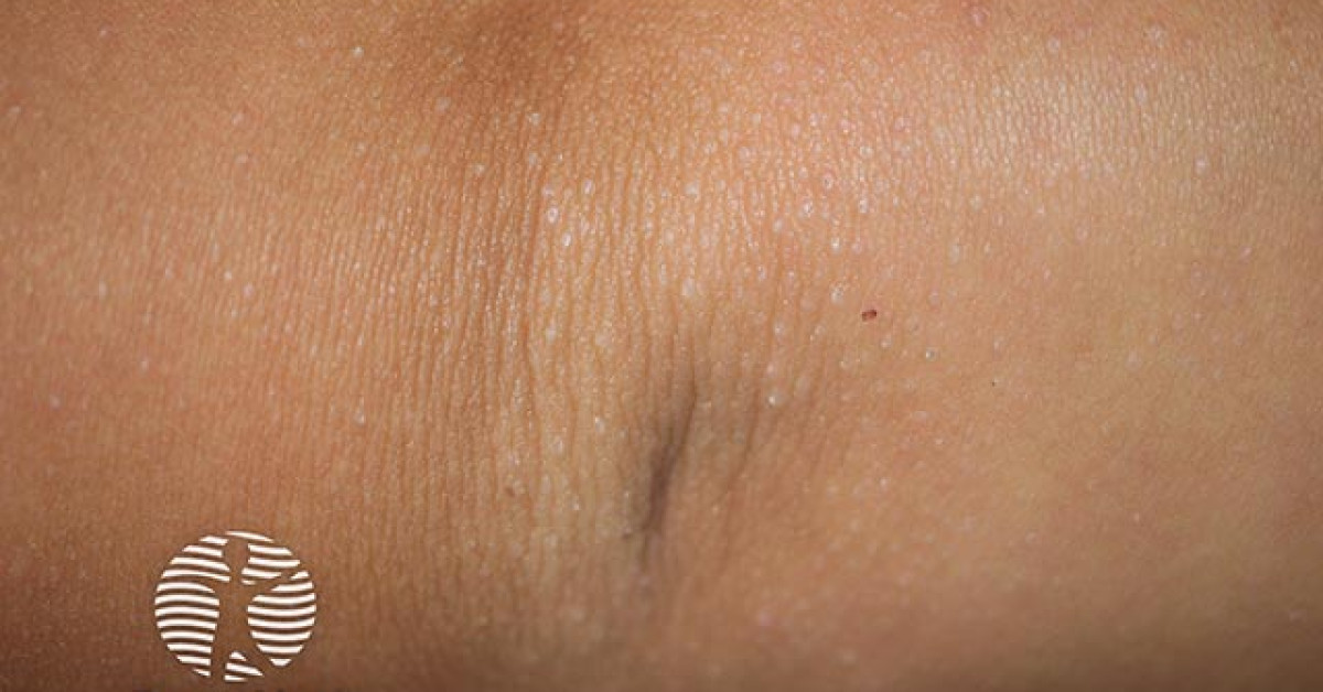 Frictional lichenoid dermatitis image