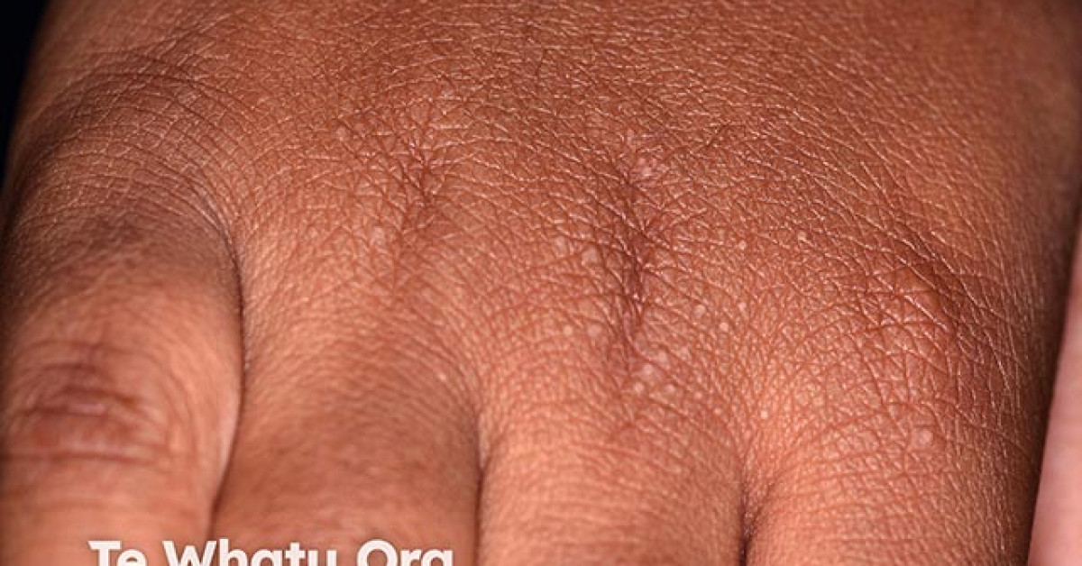 Frictional lichenoid dermatitis image