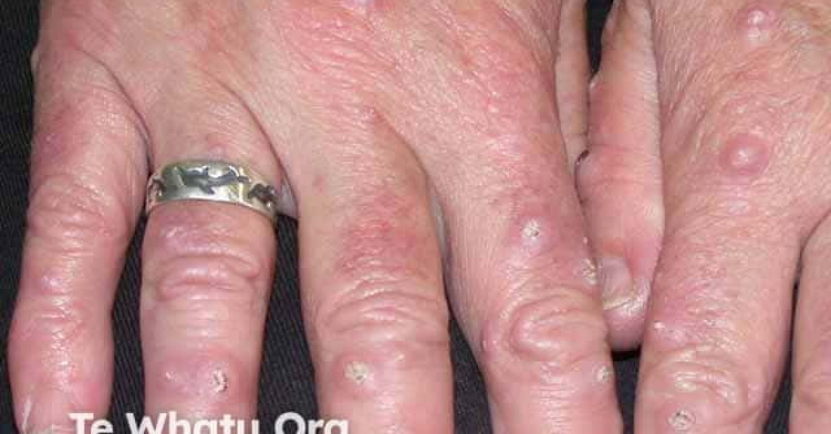 Generalised eruptive keratoacanthoma image