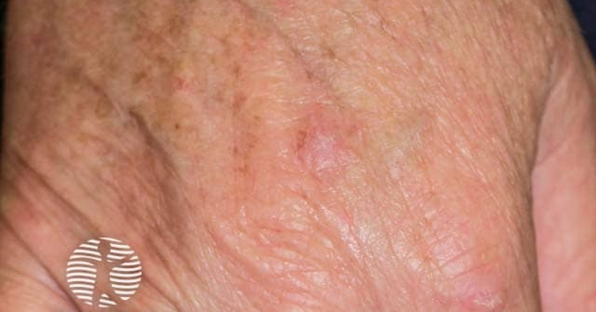 Generalised eruptive keratoacanthoma image
