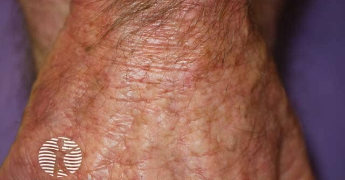 Generalised eruptive keratoacanthoma image