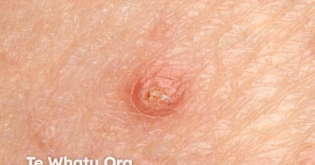 Dermnet® Generalised Eruptive Keratoacanthoma Image
