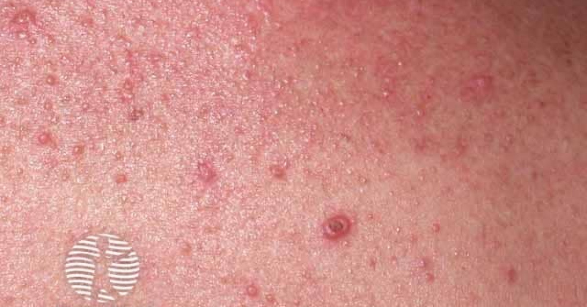 Generalised eruptive keratoacanthoma image
