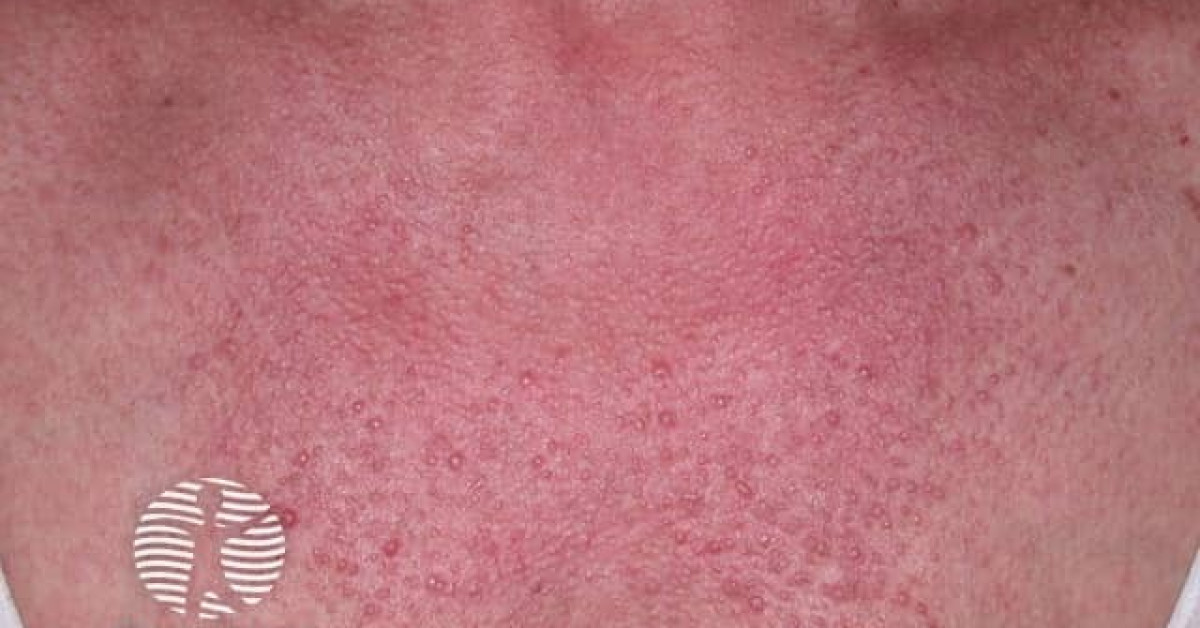 generalised eruptive keratoacanthoma 0026 image
