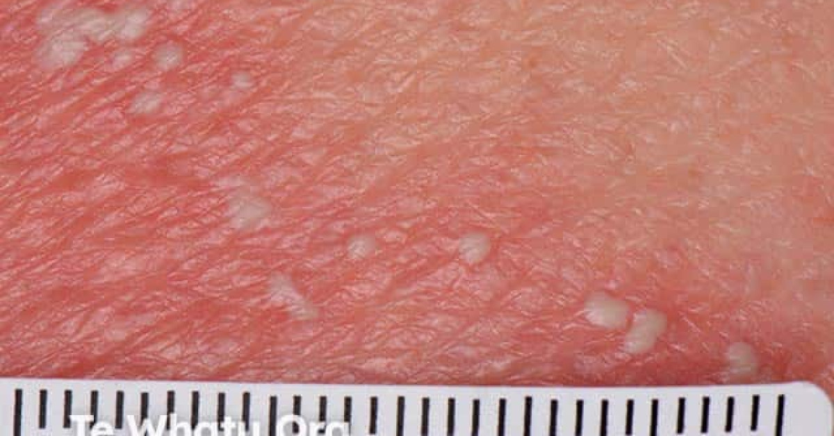 Generalised pustular psoriasis image