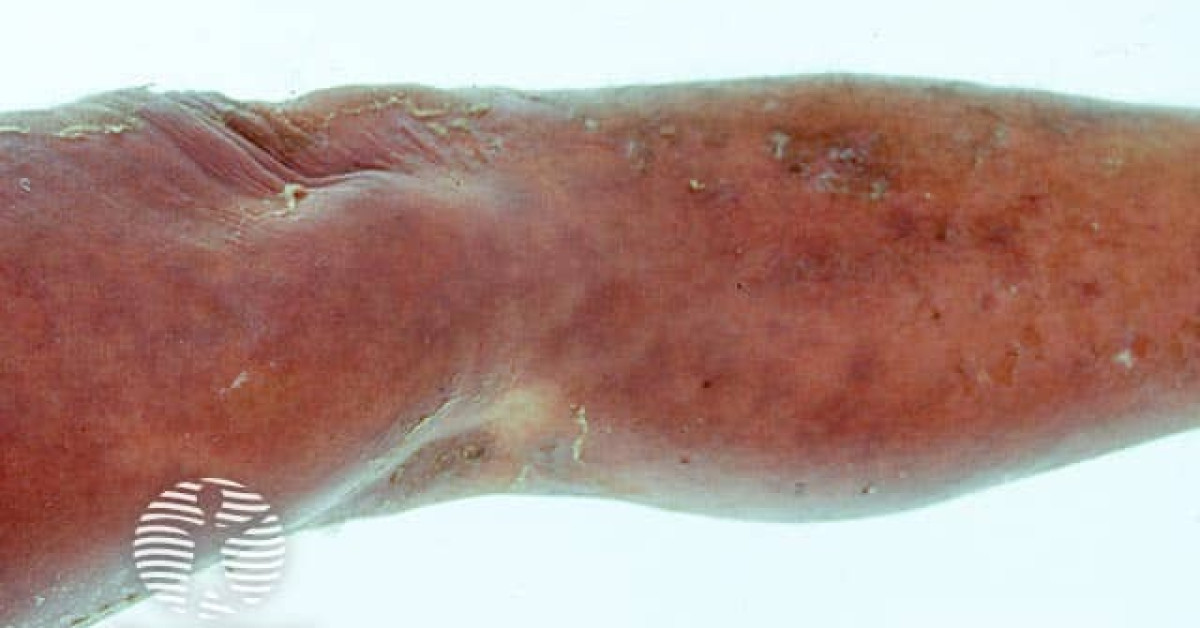 Generalised pustular psoriasis image