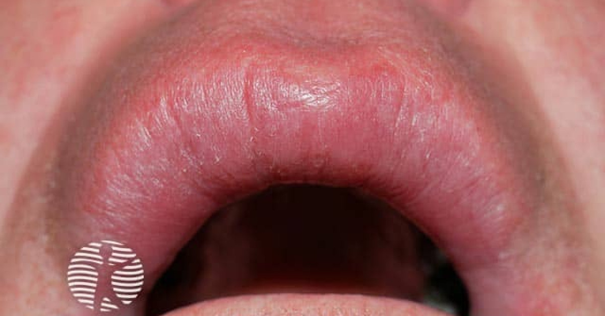 Granulomatous cheilitis image
