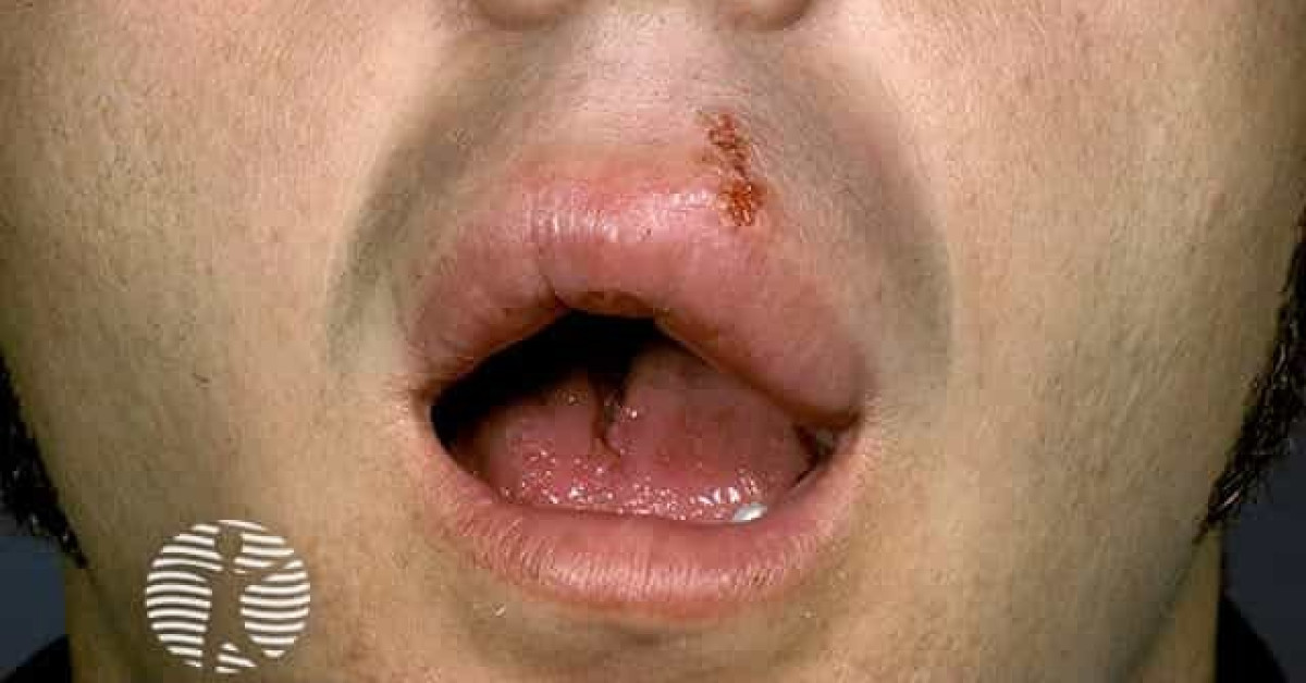 Granulomatous cheilitis image