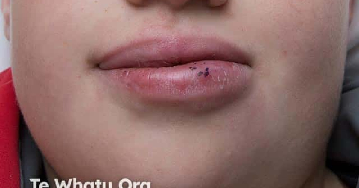 Granulomatous cheilitis image