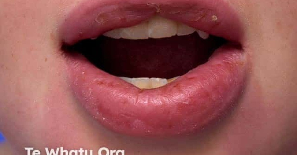 Granulomatous cheilitis image