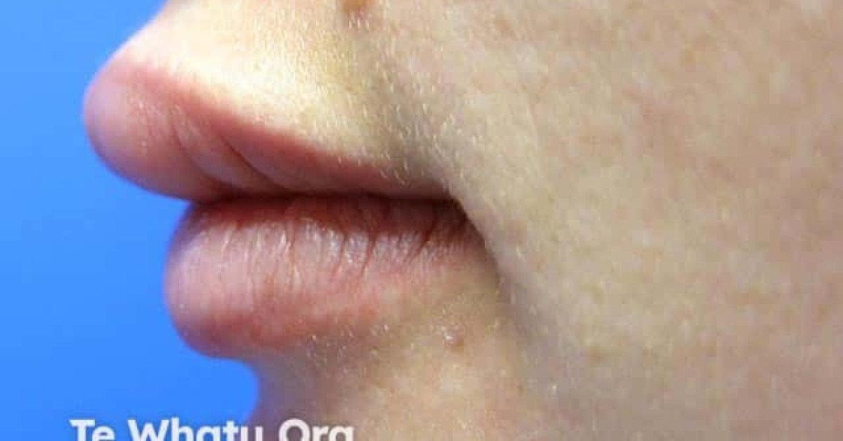 Granulomatous cheilitis image