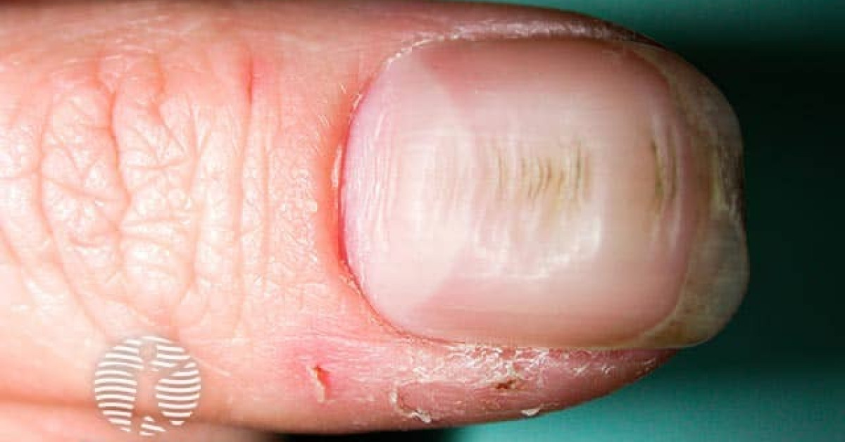Habit-tic nail deformity image