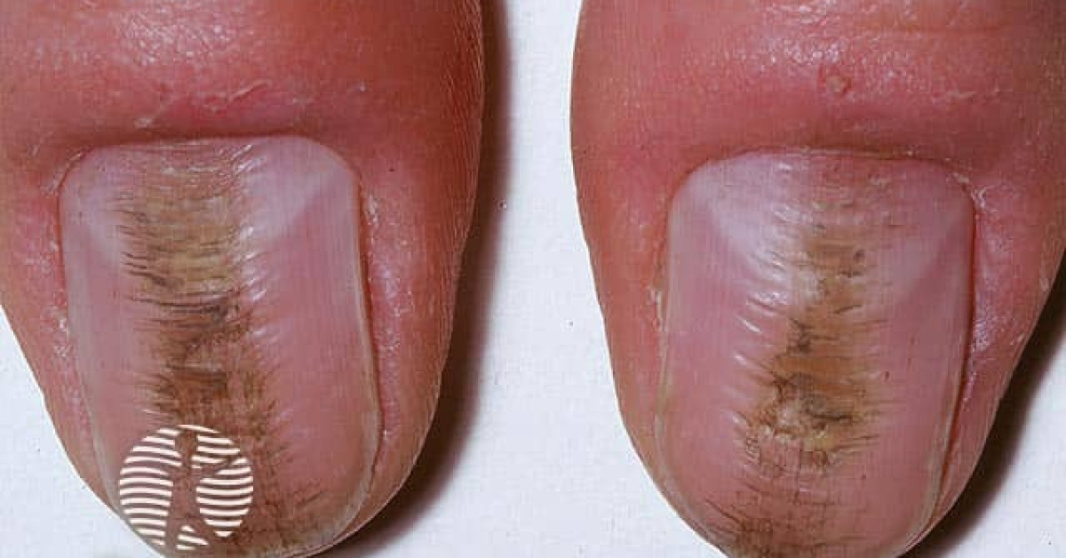 Habit-tic nail deformity image