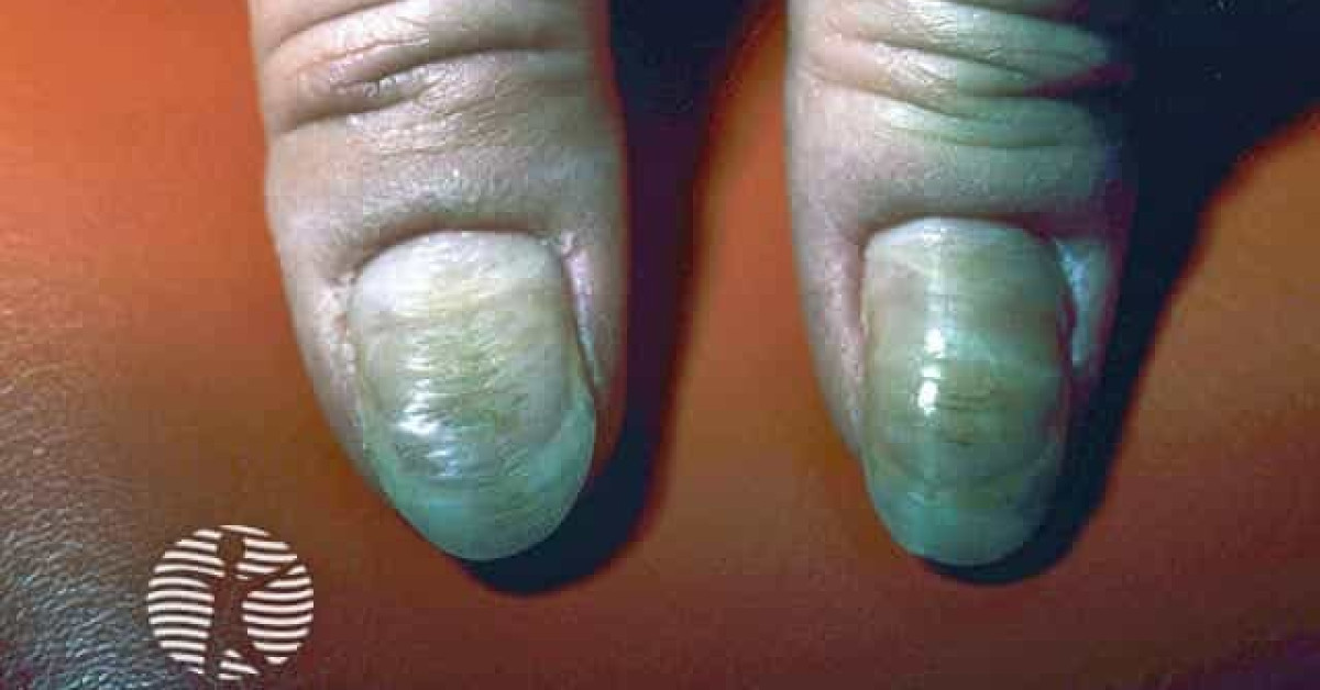 Habit-tic nail deformity image
