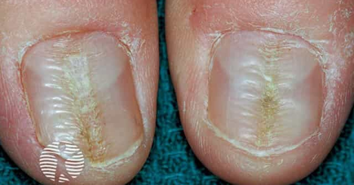 Habit-tic nail deformity image