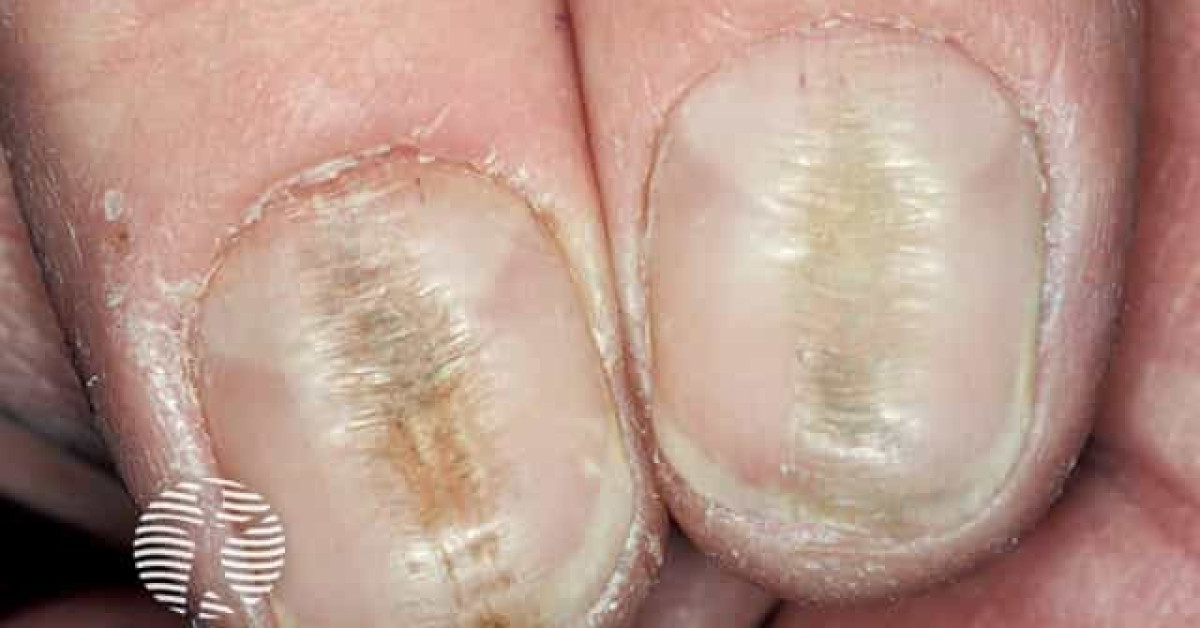 Habit-tic nail deformity image