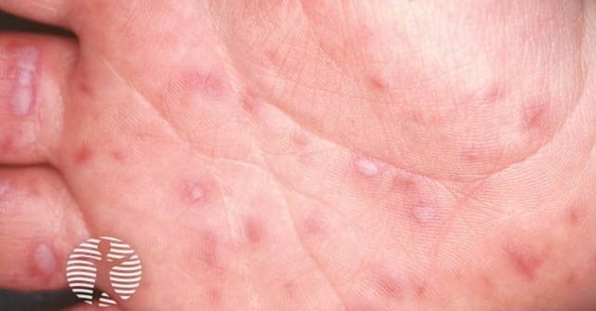 Hand, foot, and mouth disease image