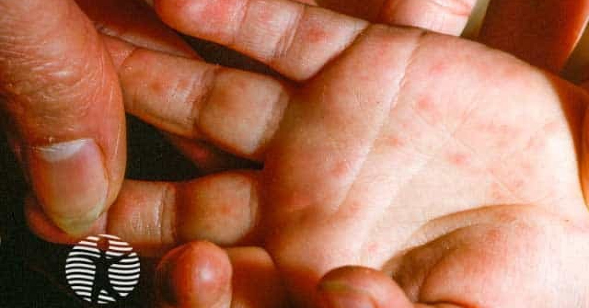 Hand, foot, and mouth disease image