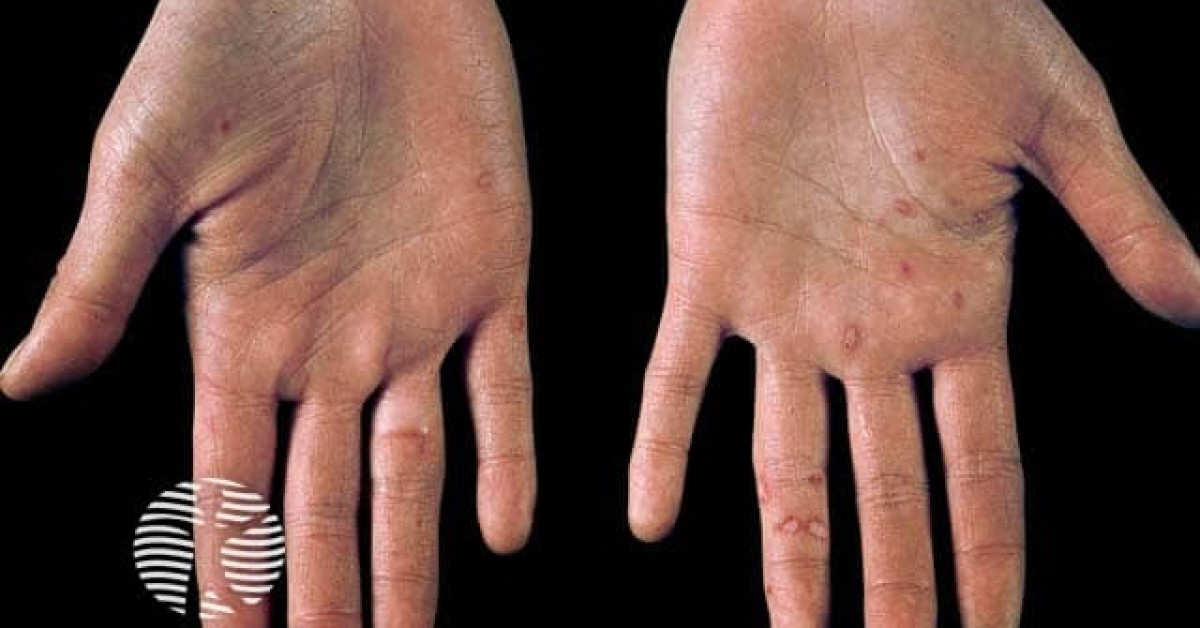 Diseases Of The Hand