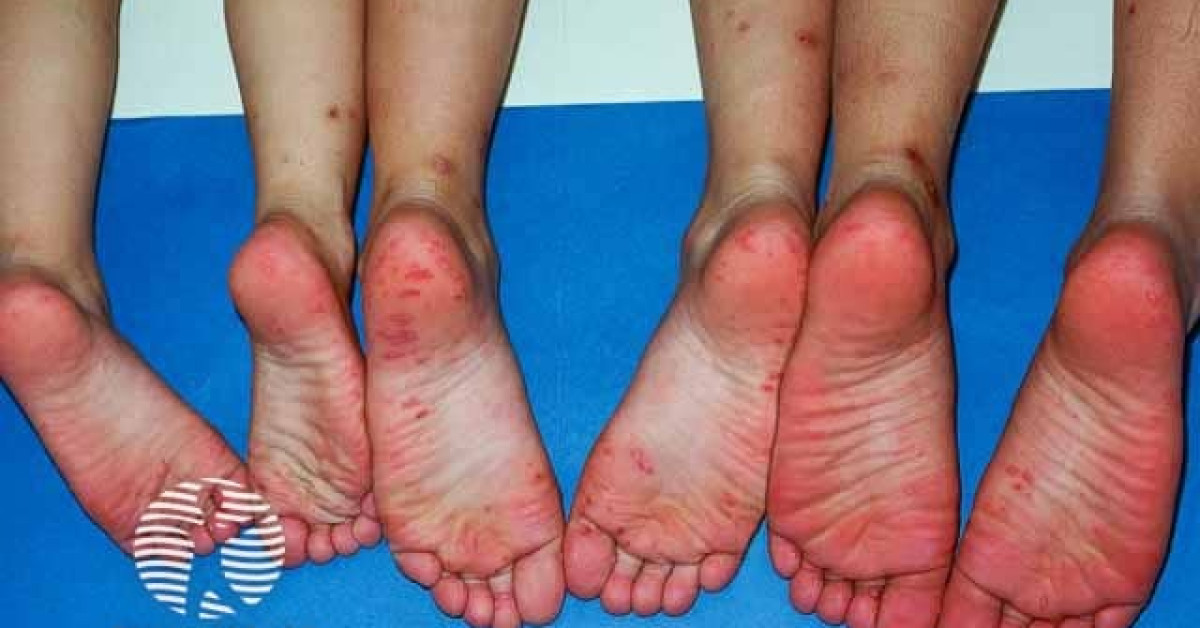 Hand, foot, and mouth disease image