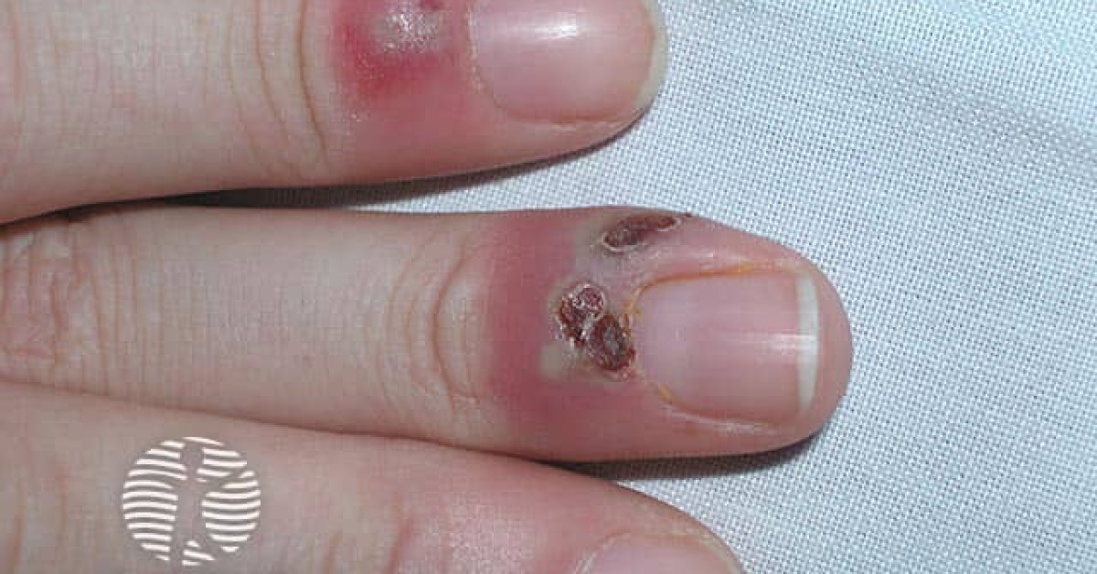 Herpetic whitlow image