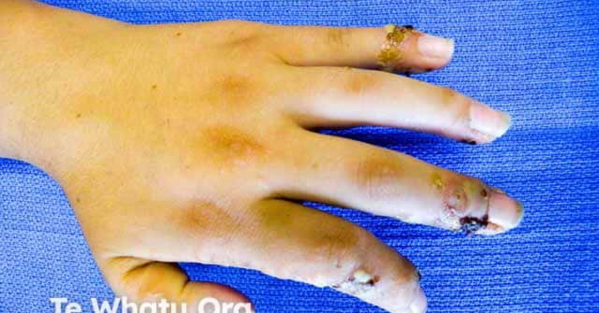 Herpetic Whitlow Pailme Self Inflicted Herpetic Whitlow | BMJ Case