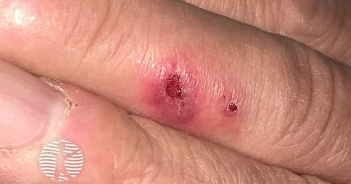 Herpetic whitlow image