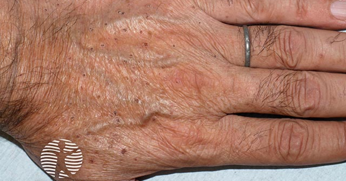Hyperkeratosis lenticularis perstans image