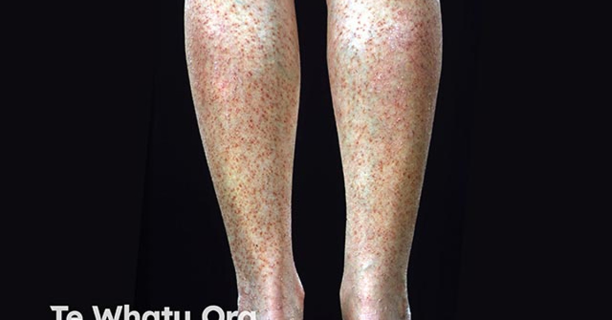 Hyperkeratosis lenticularis perstans image
