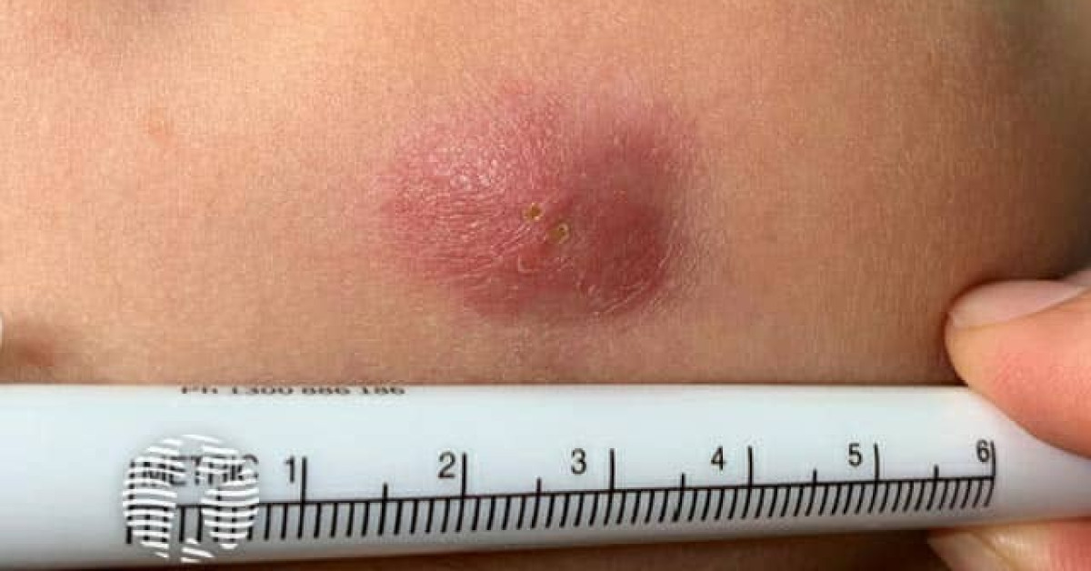 Idiopathic facial aseptic granuloma image