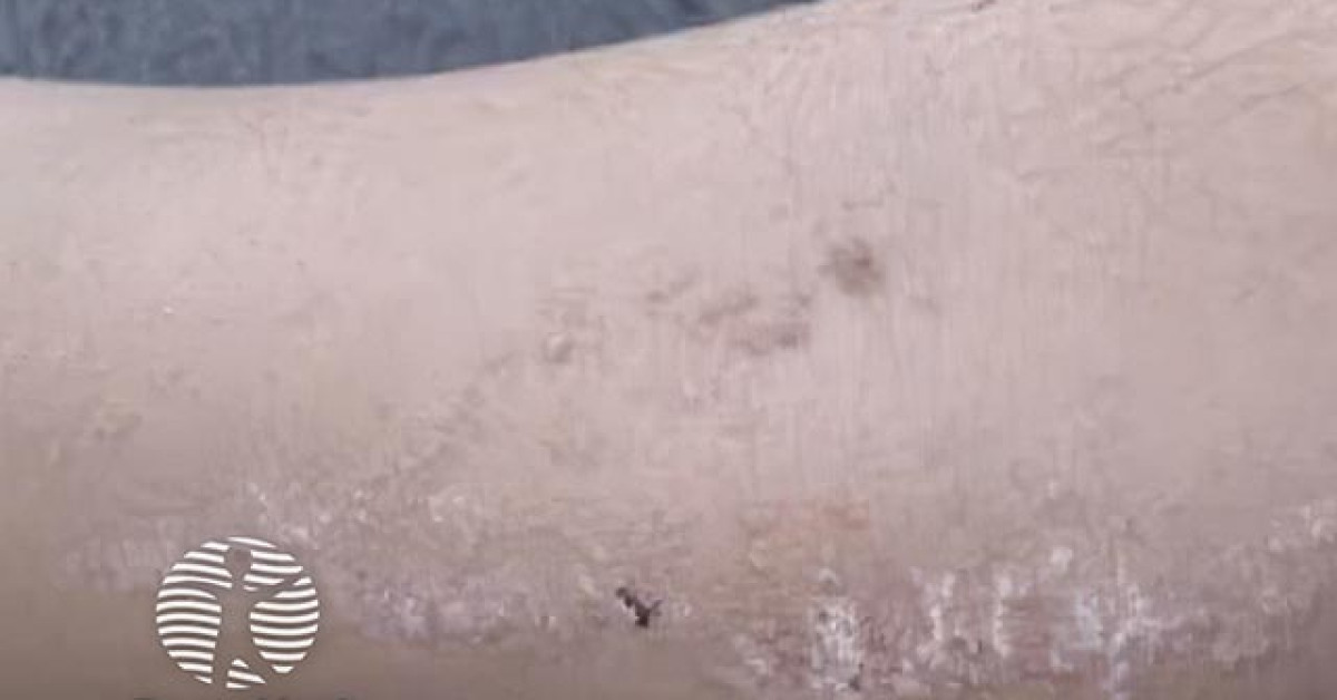 Inflammatory linear verrucous epidermal naevus image