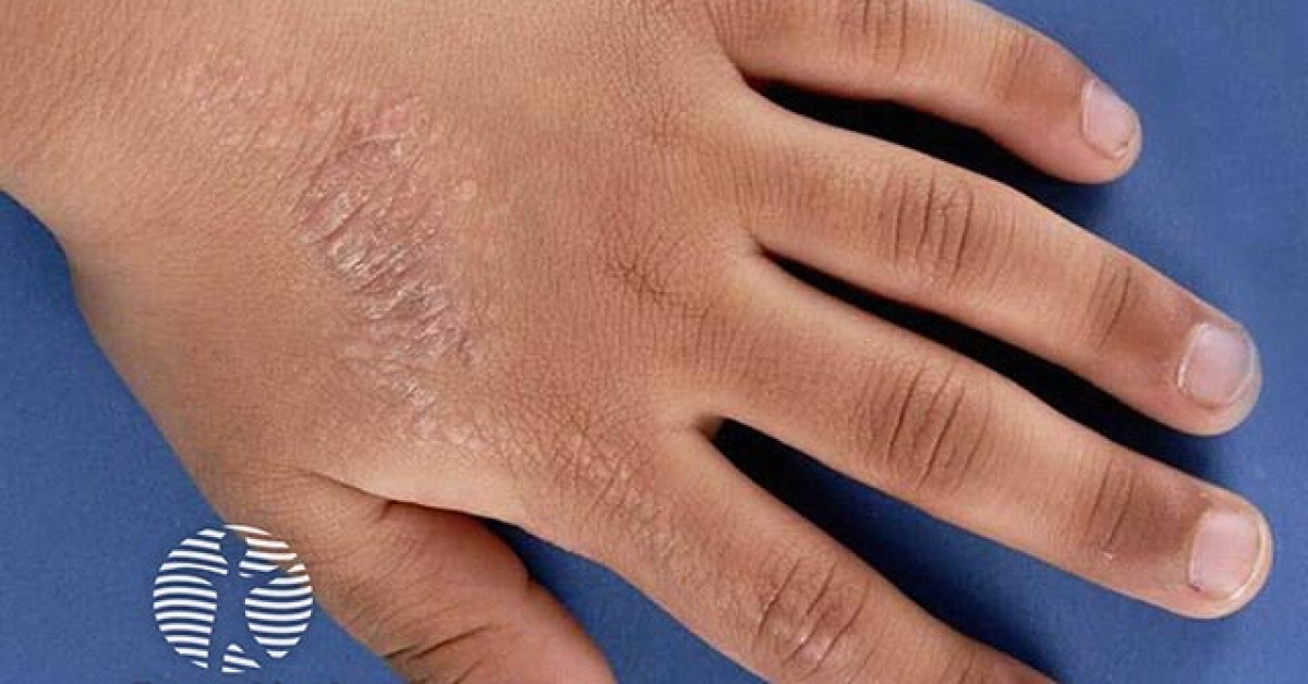 Inflammatory linear verrucous epidermal naevus image
